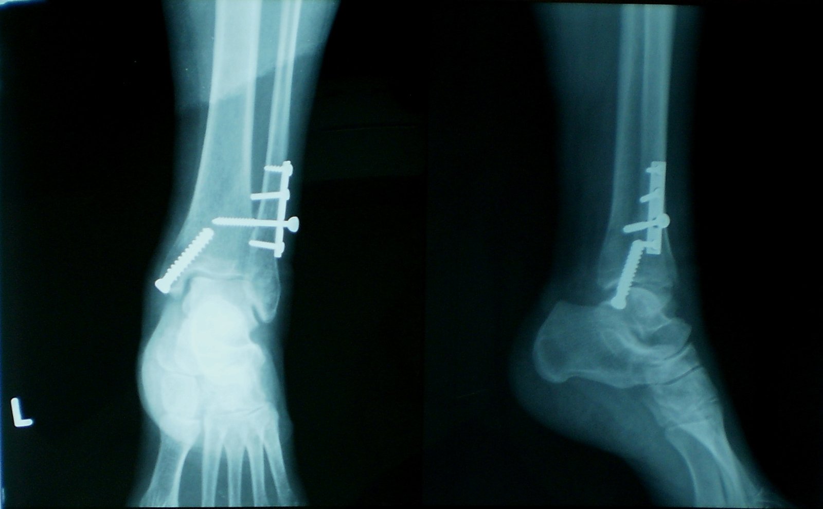 Callo en los huesos - Blog Nutriline
